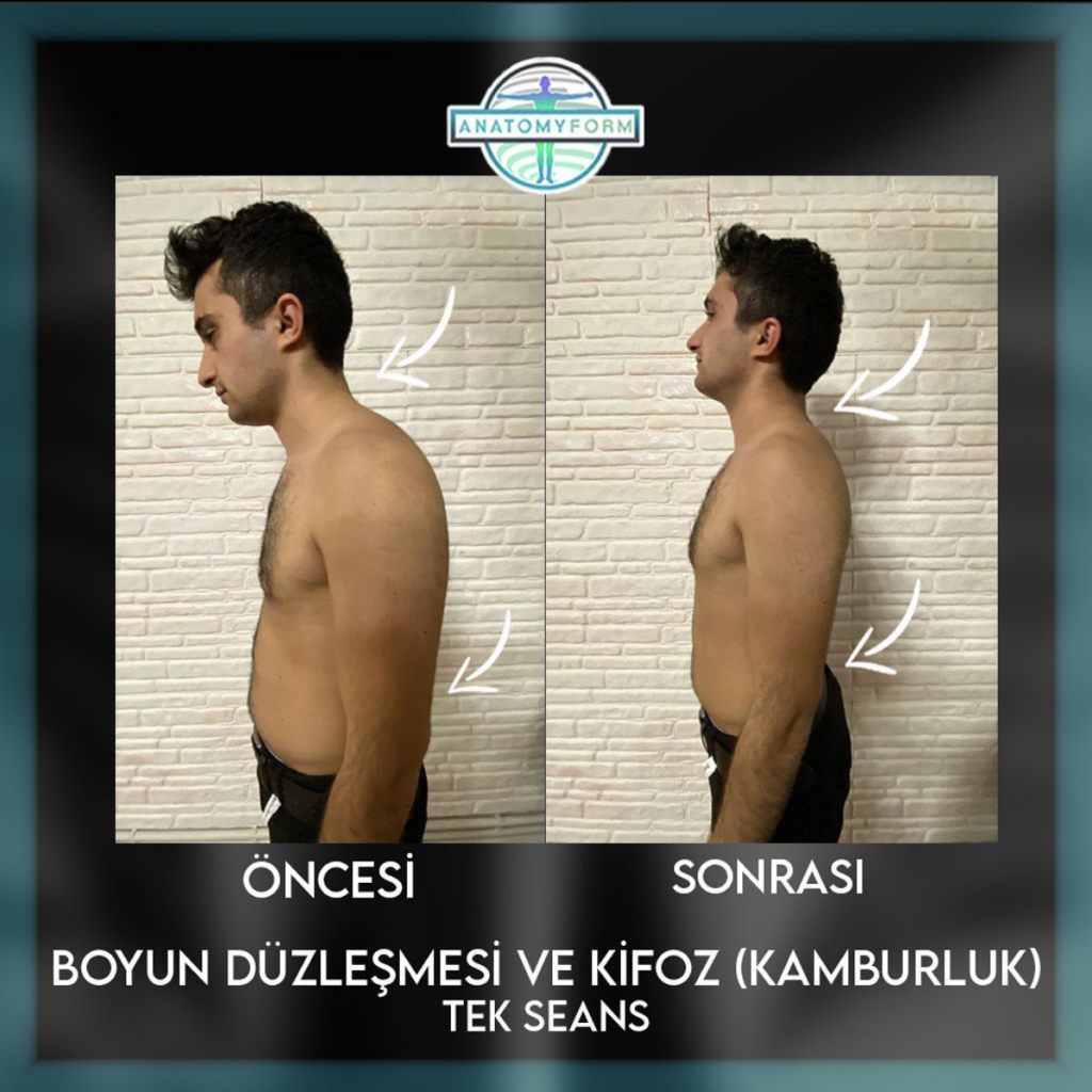 Tedavilerimiz / Boyun Düzleşmesi – Anatomy Form